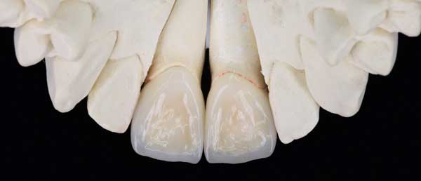 COMPARISON CHART: LAYERED VS. SOLID ZIRCONIA APPLICATIONS