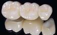 COMPARISON CHART: LAYERED VS. SOLID ZIRCONIA APPLICATIONS