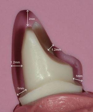 Tooth preparation for All-Ceramic Crowns