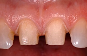 Tooth preparation for All-Ceramic Crowns