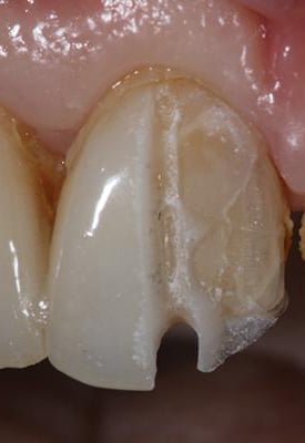 Tooth preparation for All-Ceramic Crowns