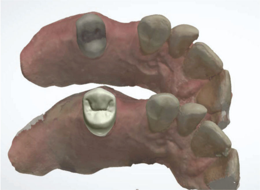 3 TECHNIQUES TO ACHIEVE OPTIMAL RESULTS WHEN PLACING A CROWN UNDER A ...