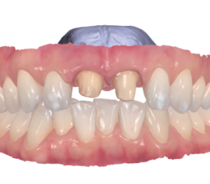 Optimal clinical margins and digital dental scans
