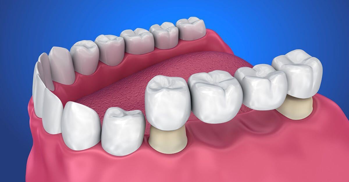 The Ultimate Dentist's Guide to Crown & Bridge