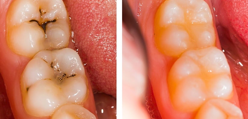 COMPOSITE TECHNIQUES IN DENTISTRY