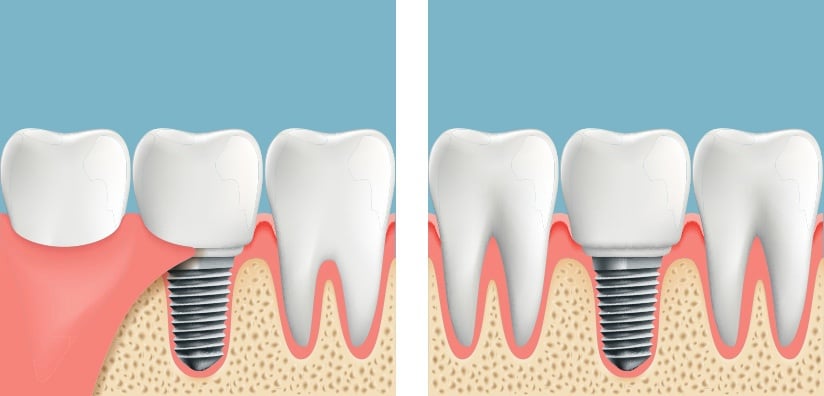 GUIDED BONE REGENERATION IN IMPLANT DENTISTRY