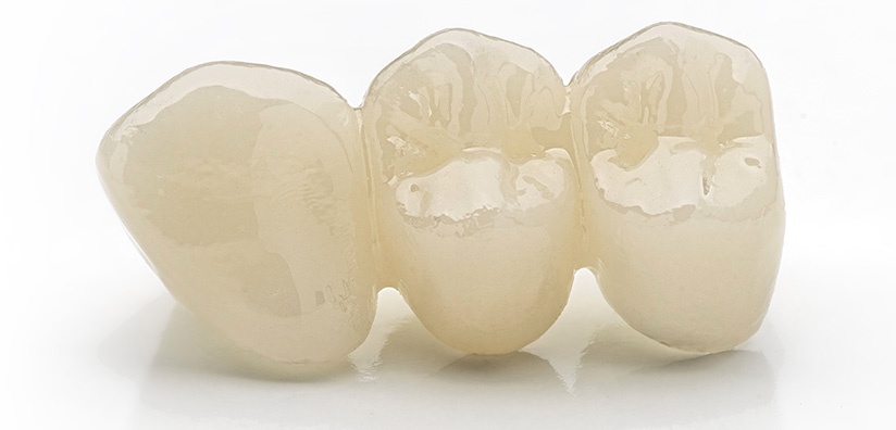 ZIRCONIA BRIDGES: Know when to select Zirconia for a bridge