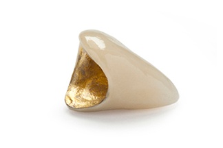 Full cast crown and bridge, PFMs and all-ceramic restorations