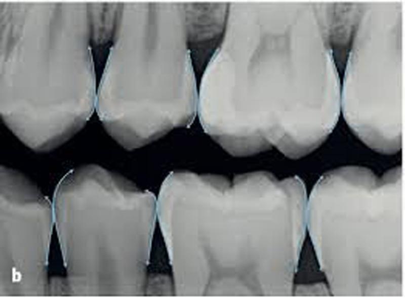How to ensure a dental crown fits | Dispatch #7