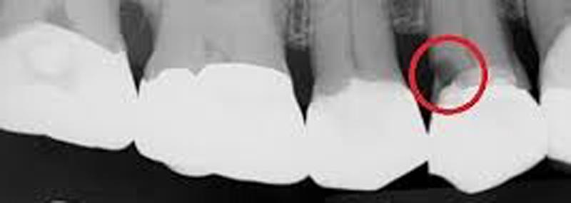 How to ensure a dental crown fits | Dispatch #7