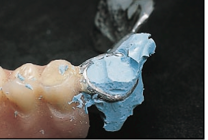 FABRICATING A CROWN UNDER AN EXISTING REMOVABLE PARTIAL DENTURE ...