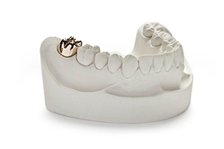 Full cast crown and bridge, PFMs and all-ceramic restorations