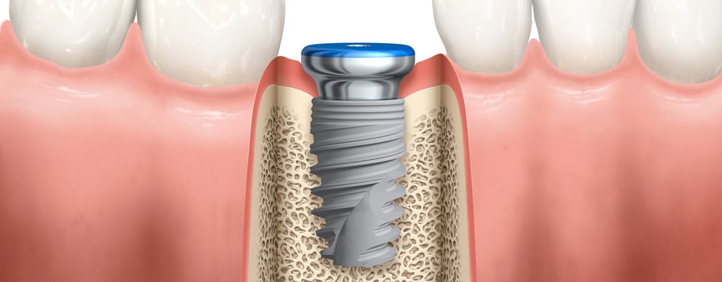How to optimize the emergence profiles of implant-supported restorations