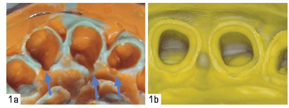 Most common dental impression errors and how to avoid them