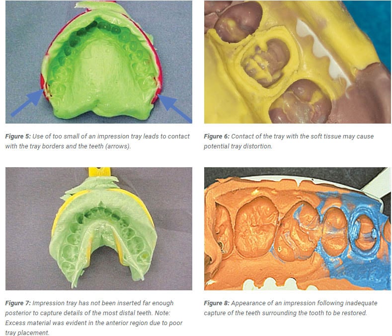 Most common dental impression errors and how to avoid them