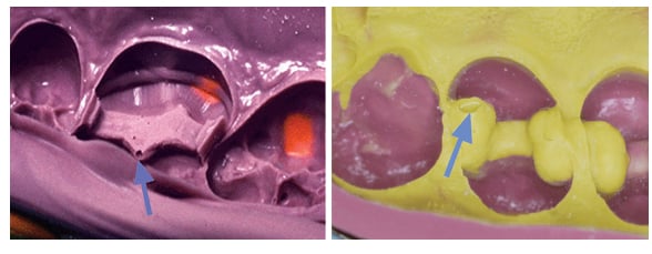 Most common dental impression errors and how to avoid them