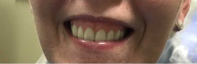 TIPS FOR A SUCCESSFUL DENTURE TEETH TRY IN