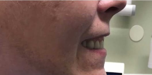 TIPS FOR A SUCCESSFUL DENTURE TEETH TRY IN