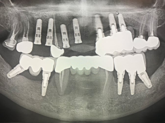 PATIENT SPOTLIGHT: Transformative screw-retained bridge
