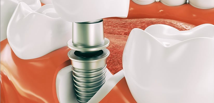 SCREW-RETAINED IMPLANT CROWN