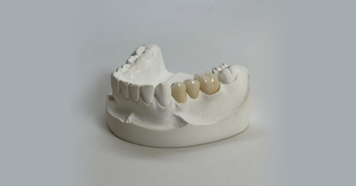 Guide to Dental Glues and Bonding Materials for Crowns