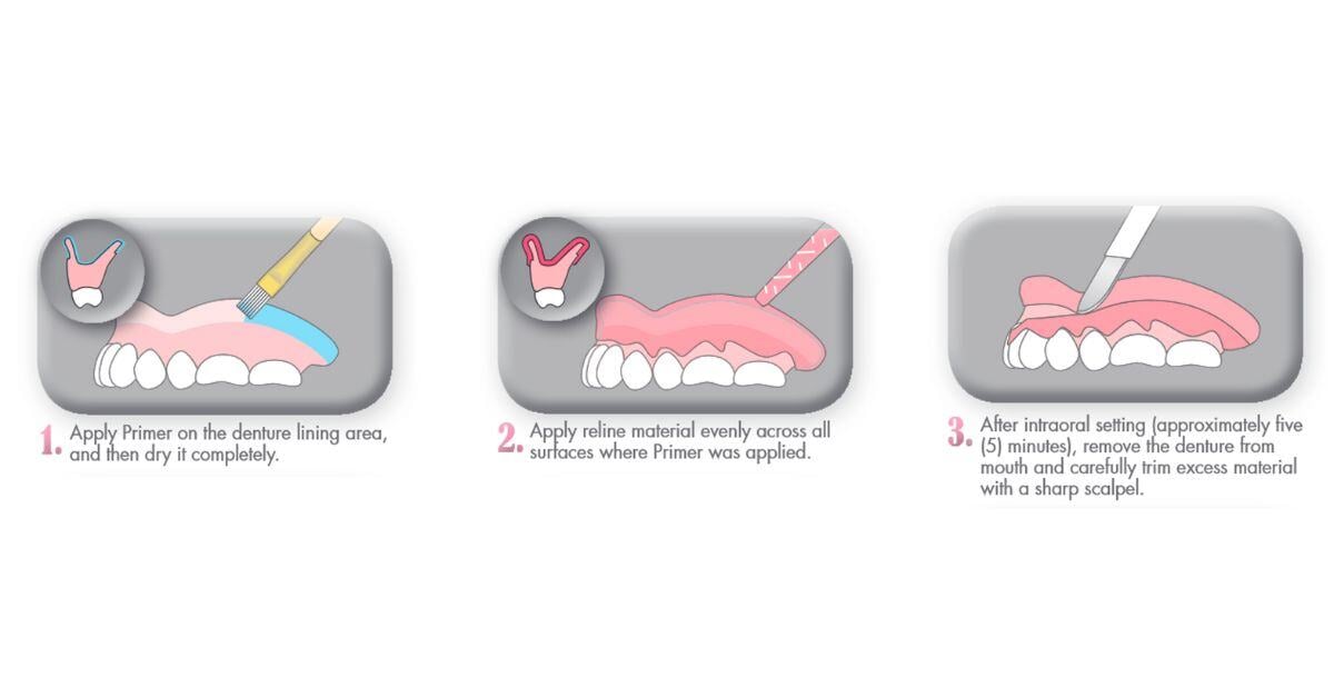 3 Things You Should Know About Relining 3D Printed Digital Dentures