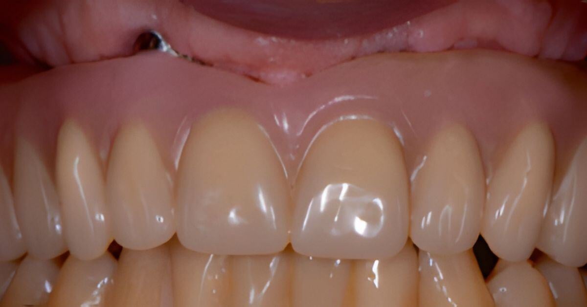 A Look at Overdentures as an Alternative to Standard Dentures