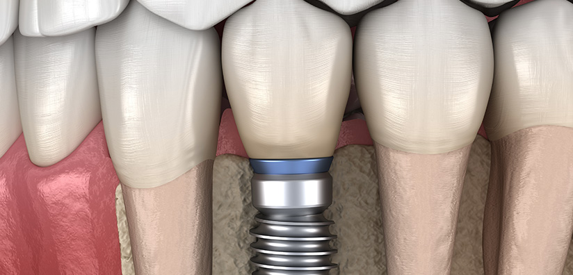 LEARN HOW NERVE ELECTRICAL STIMULATION ENHANCES OSSEOINTEGRATION OF ...