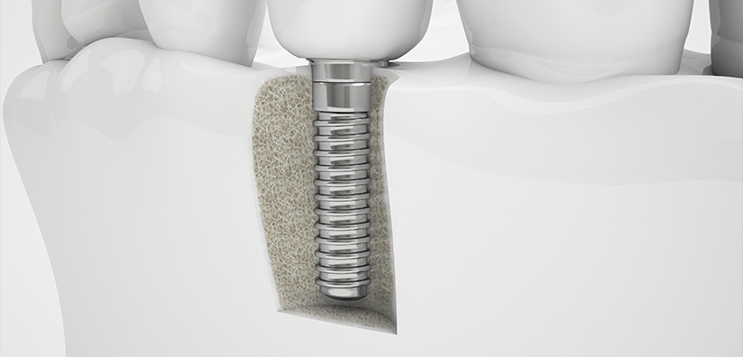 WHEN TO USE NARROW DIAMETER DENTAL IMPLANTS