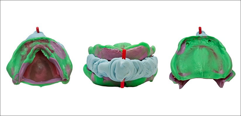 CORRECTLY USING YOUR BASE PLATE BITE RIMS TO RECORD MEASUREMENTS
