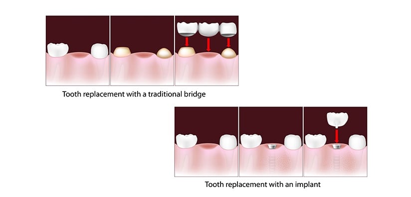 TOOTH REPLACEMENT: Implant versus Bridge
