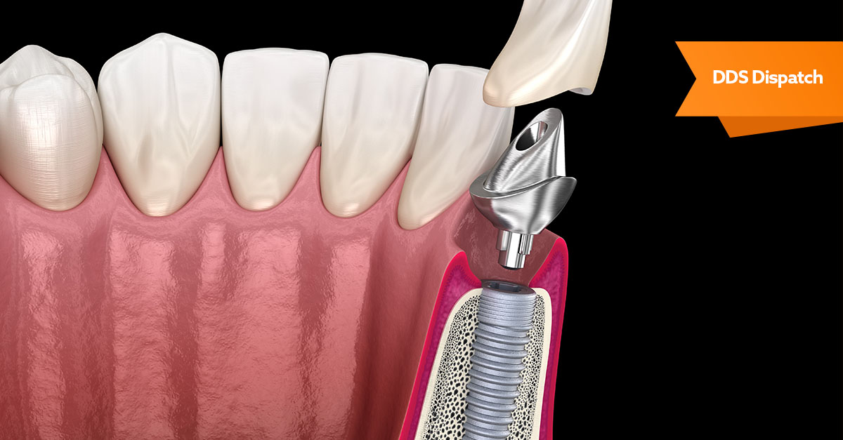 How to optimize the emergence profiles of implant-supported restorations
